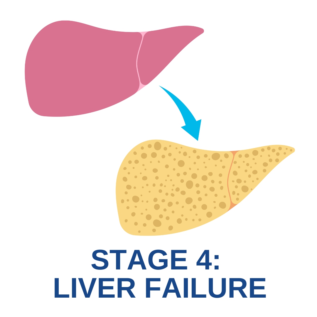 What Are The Four Stages of Liver Disease